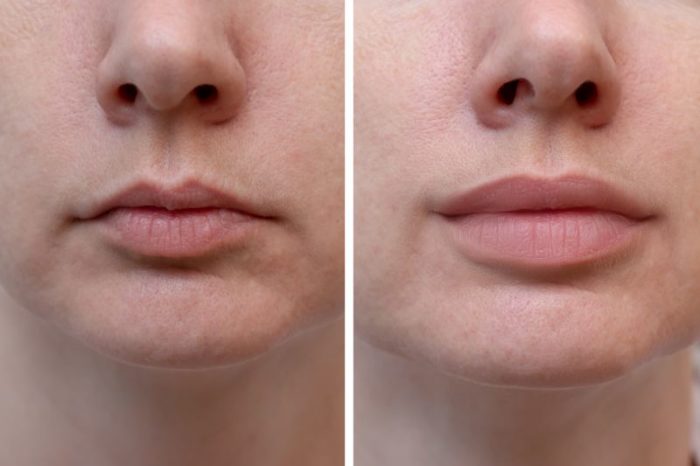 Lip Filler Vorher Nachher